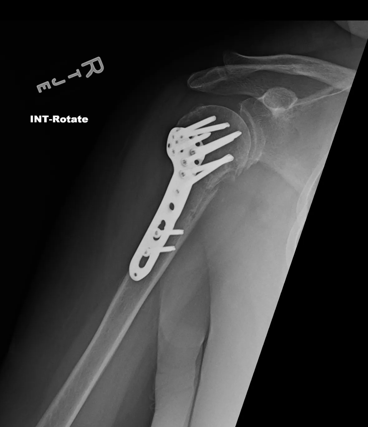 Healing a Broken Arm by Sheri LeClair Banitt – themillennialboomer